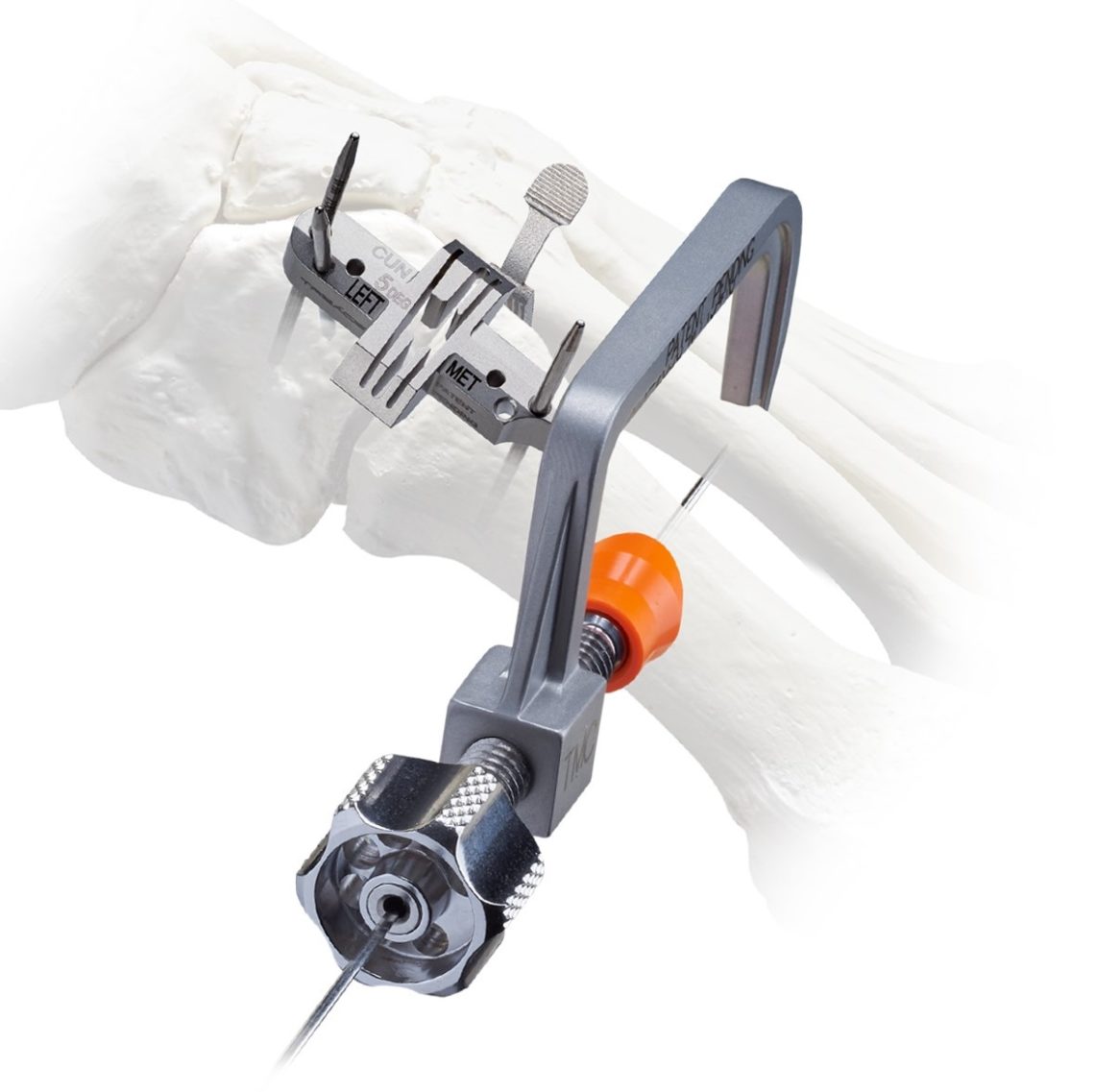 Lapiplasty - NTFANTFA