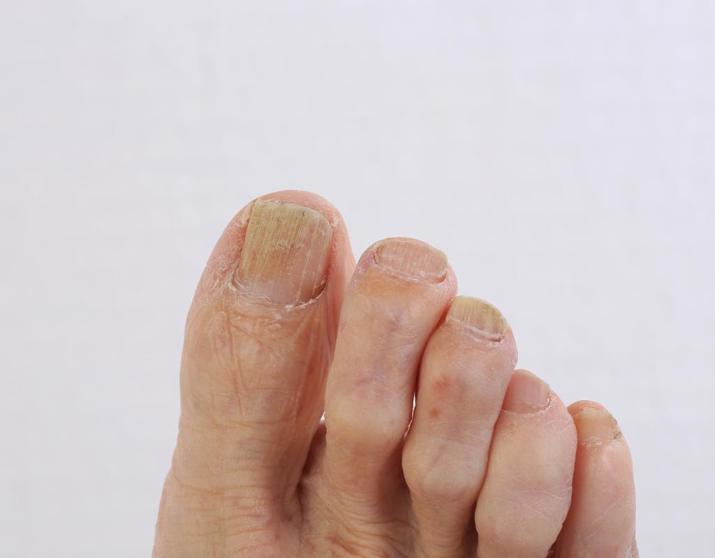 Types of Foot Fungus and How to Prevent Them - NTFA