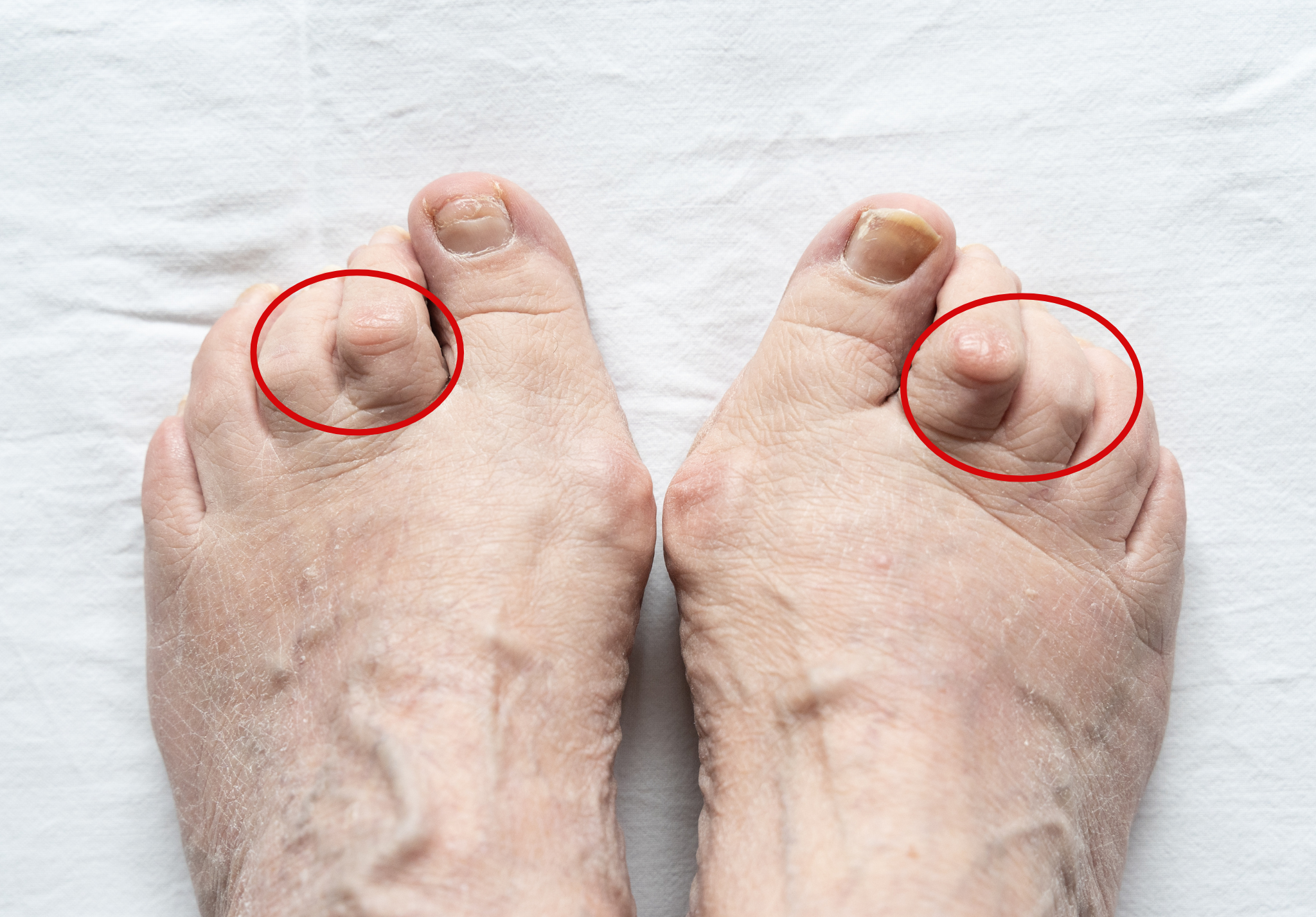 A Guide to Understanding the Difference Between Bunions and Hammertoes ...